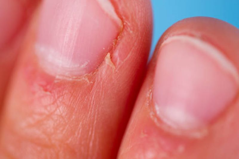 Hangnail Care: Pro Tips from Healthcare Workers | Zanova Mask